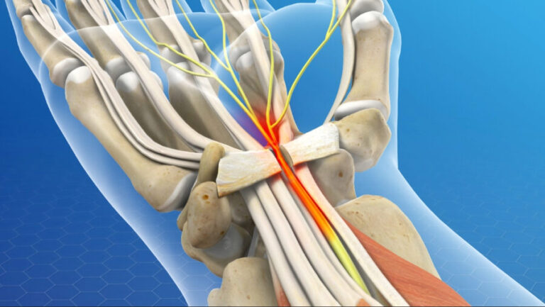 Carpal Tunnel Release Surgery Guide | IntegraMed