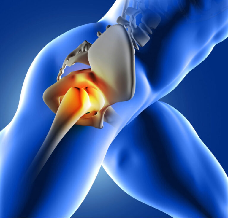 Hip Arthroplasty Surgery Guide | IntegraMed