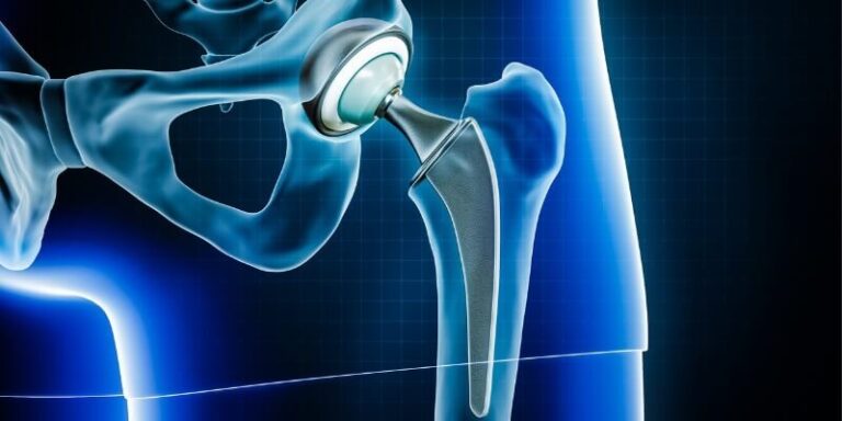 Hip Arthroplasty Surgery Guide | IntegraMed