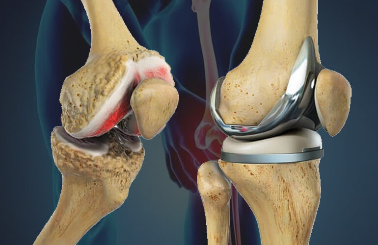 Carpal Tunnel Release Surgery Guide | IntegraMed